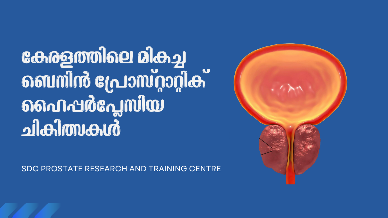 Prostatic hyperplasia treatment in Kerala - sdcprostatecentre.com