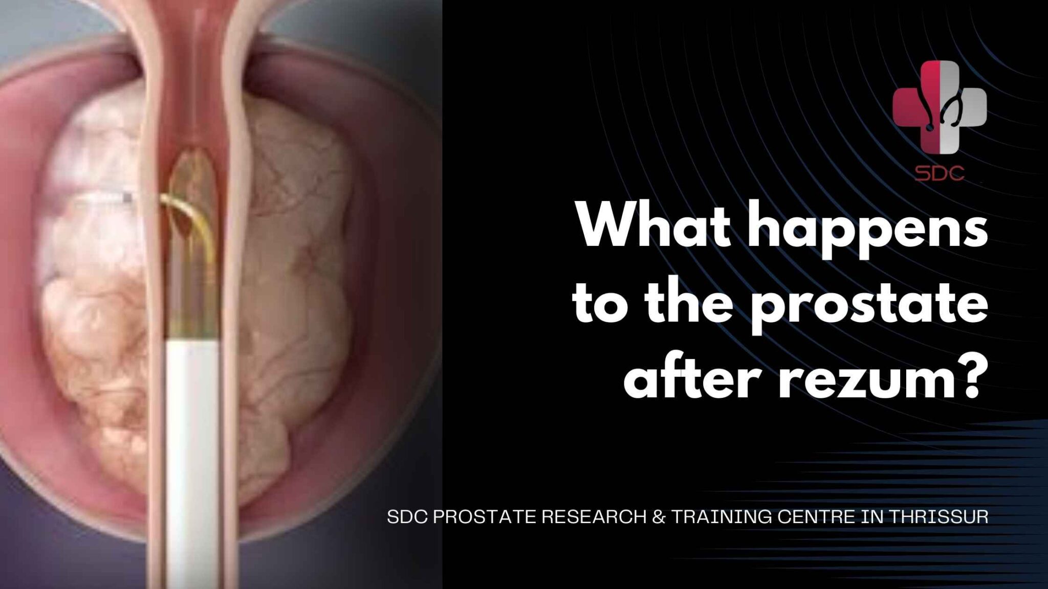 What Happens to the Prostate After REZUM? - sdcprostatecentre.com
