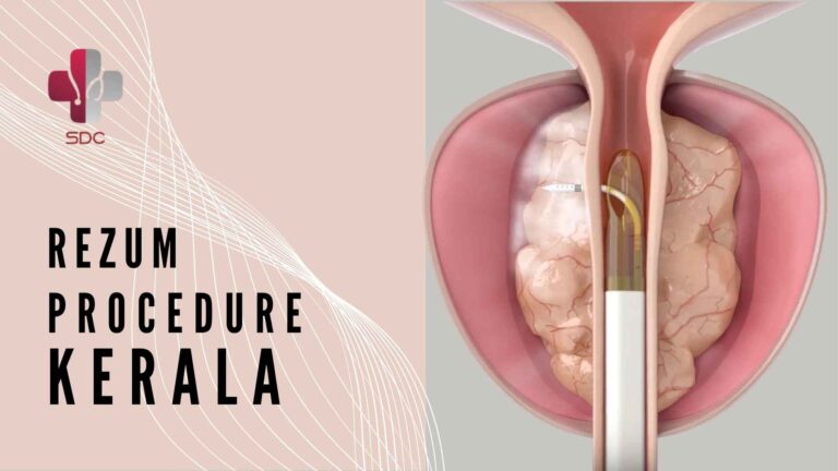 Rezum Procedure Kerala - sdcprostatecentre.com