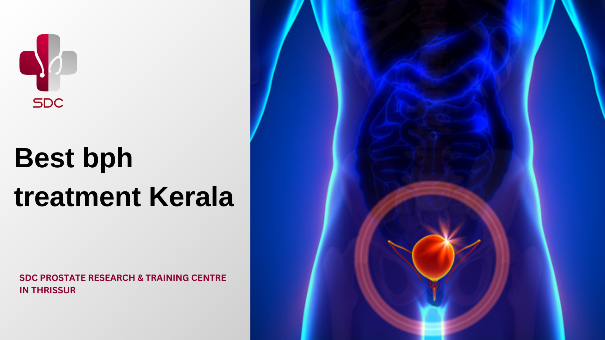Best BPH Treatment in Kerala - sdcprostatecentre.com