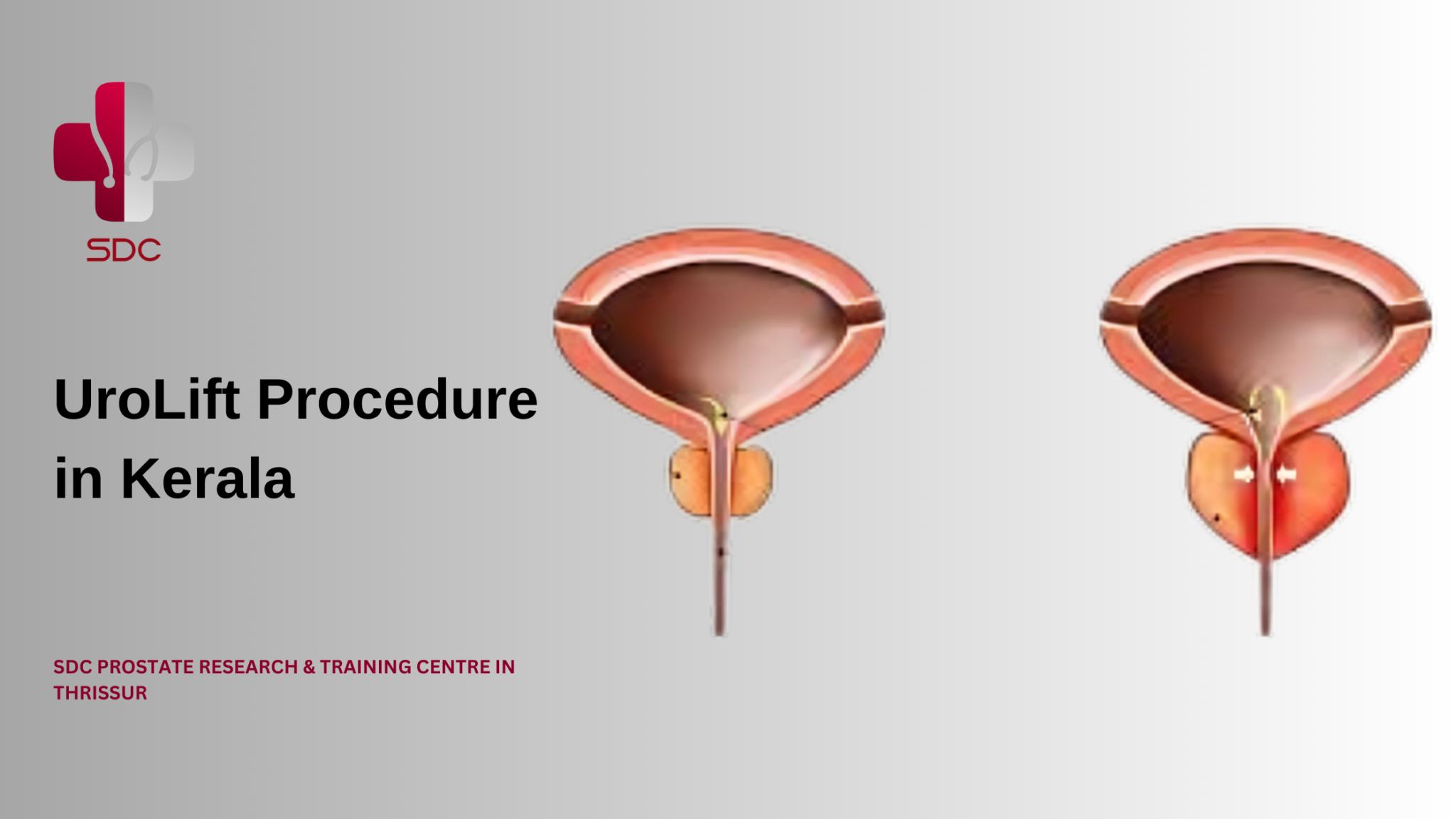 UroLift Procedure in Kerala - sdcprostatecentre.com